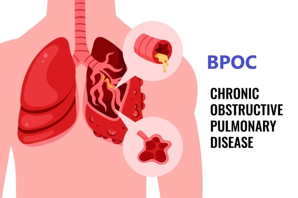 Bpoc tratament naturist in salina cu aerosoli salini uscati